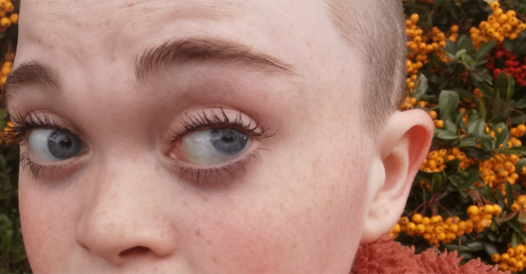 Congenital anosmia and visual impairment Claire-Louise Pitman